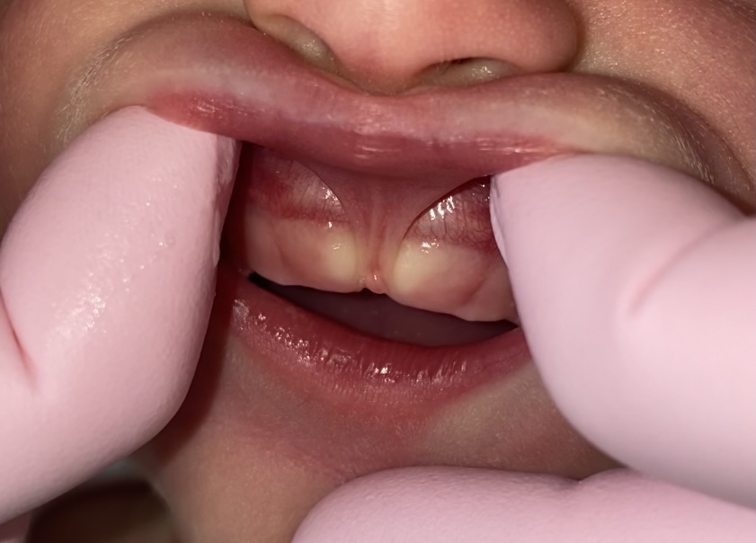 Labial Frenulum Laceration